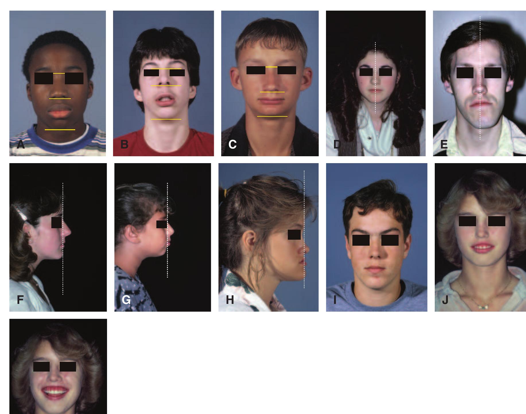 10. a-k, facial form in vertical, transverse, and profile