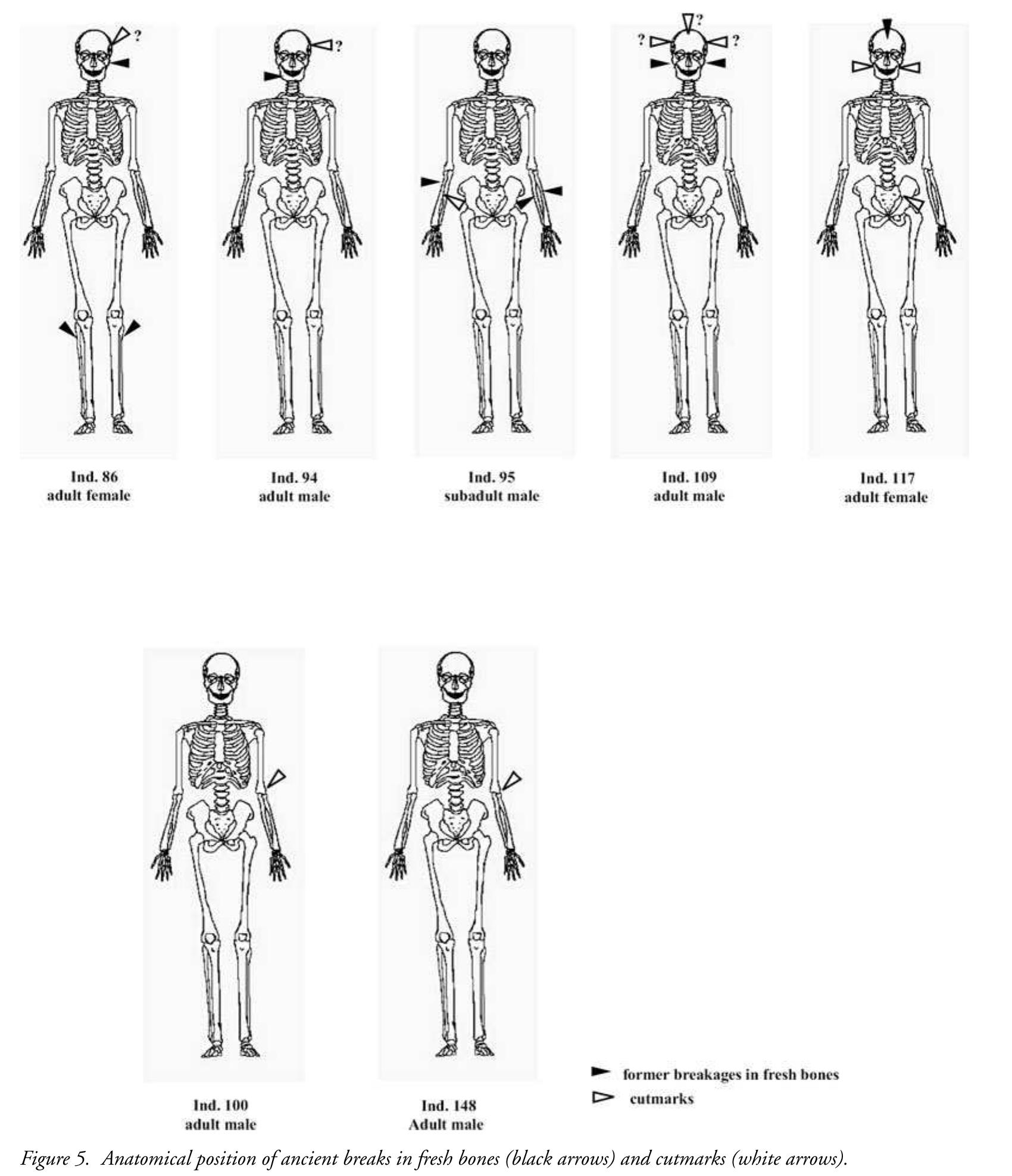 Of fractures of spiral form. the bones of the cranial vault,
