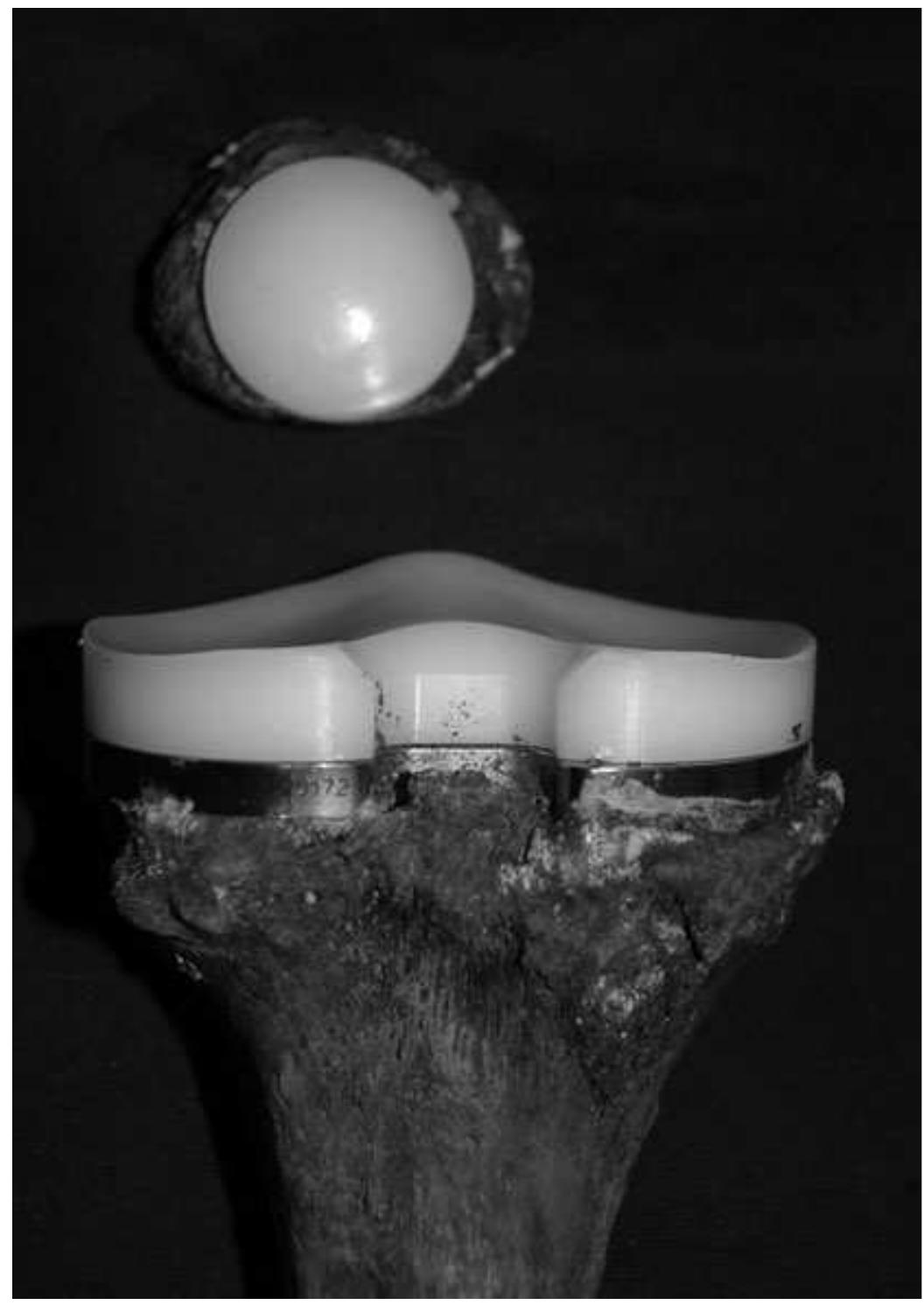 —a posterior view of a knee replacement with the tibia