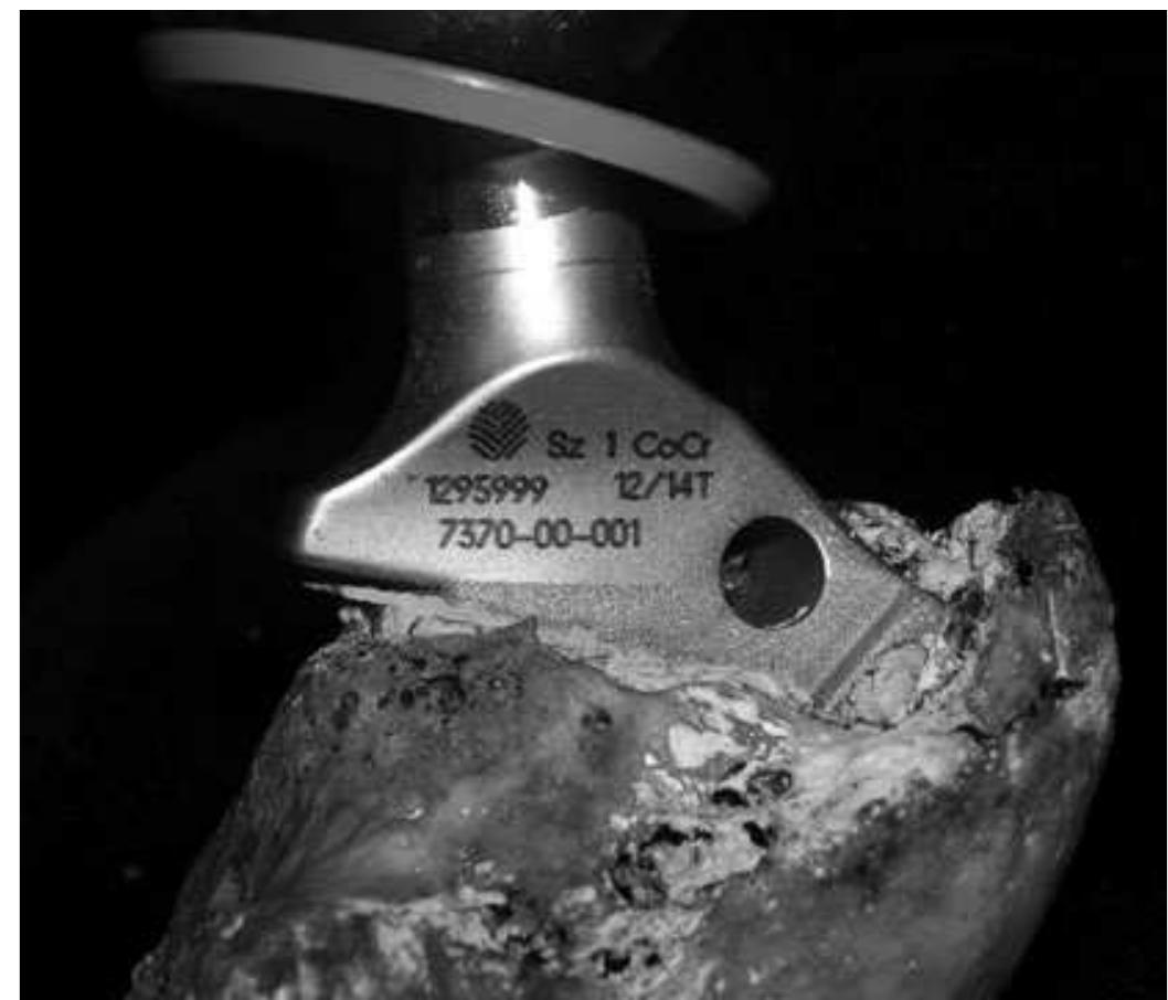 —an example of a femoral implant that clearly indicates the