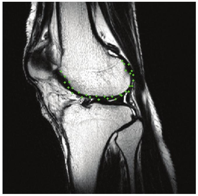 Figure 6 Quantification And Visualization Of Mri Cartilage