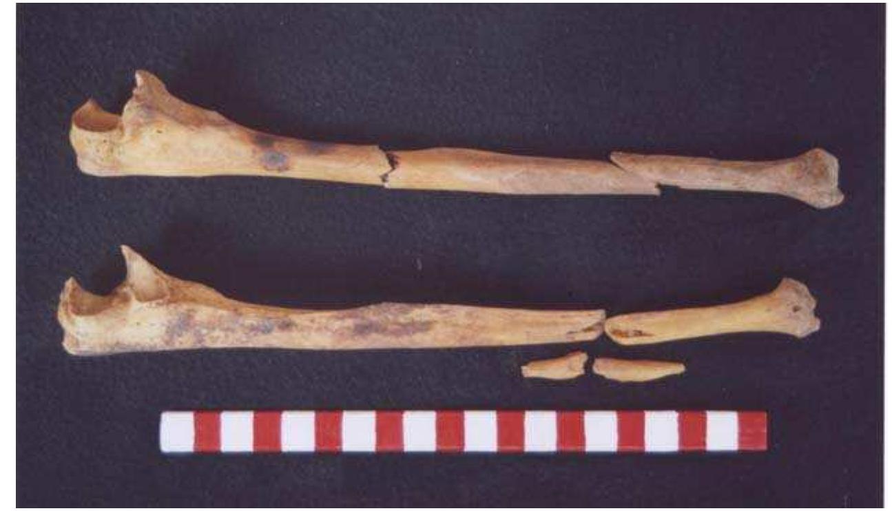 1. perimortem fractures of the left and right ulnae of body