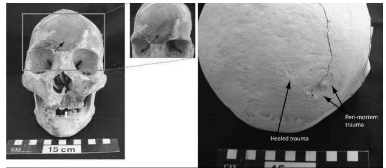 Healed blunt force trauma on the frontal bone of an adult