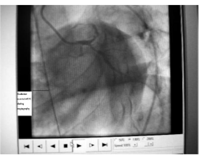 Lost guide wire visualized in inferior vena cava [ivc