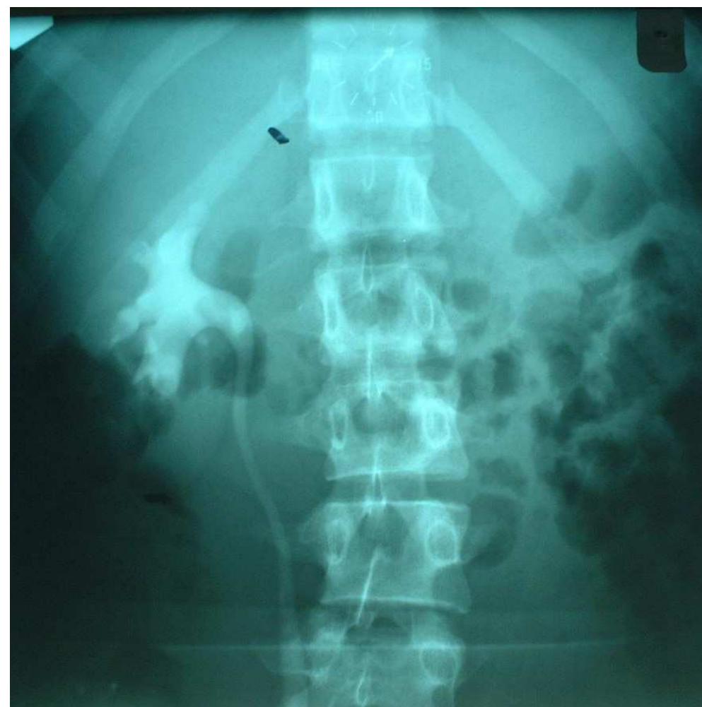 Intravenous urogram showing absence of the left kidney thus,