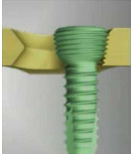 Figure 90 - Plate Fixation in Orthopaedics