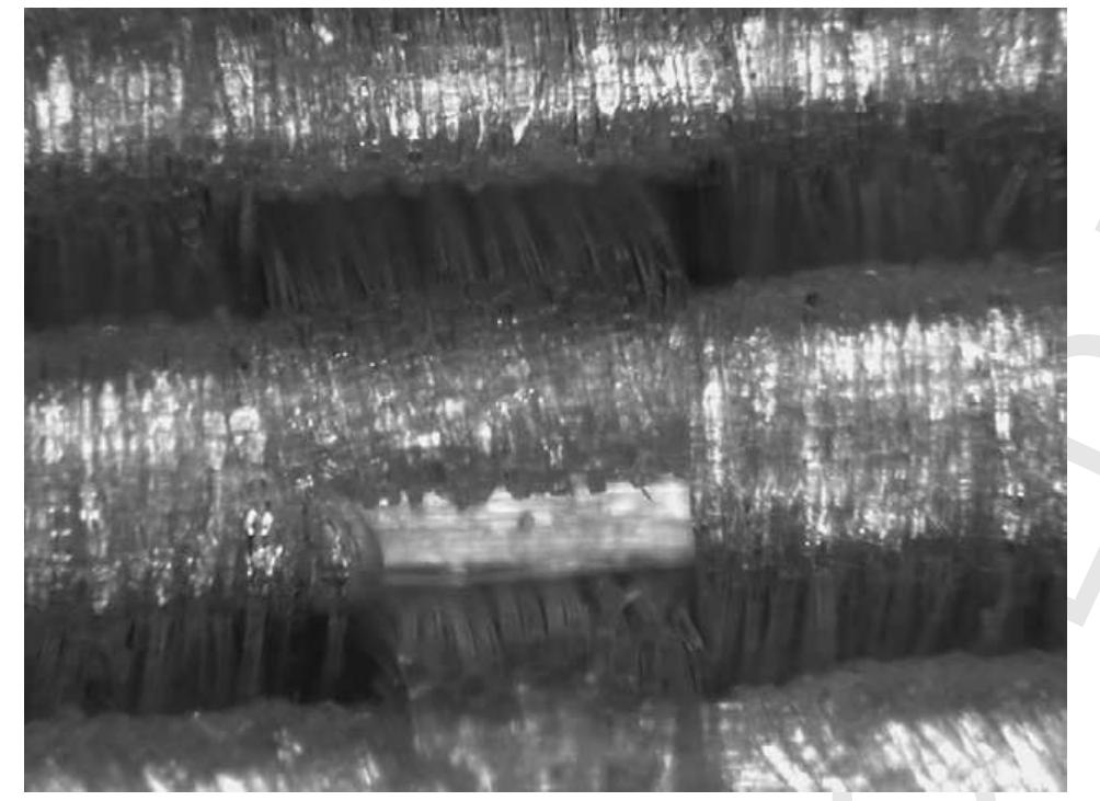 - rupture of transverse fiber at an intersection within the