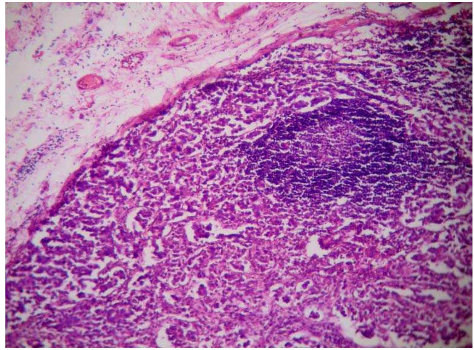 : photomicrograph showing lymph node metastasis of