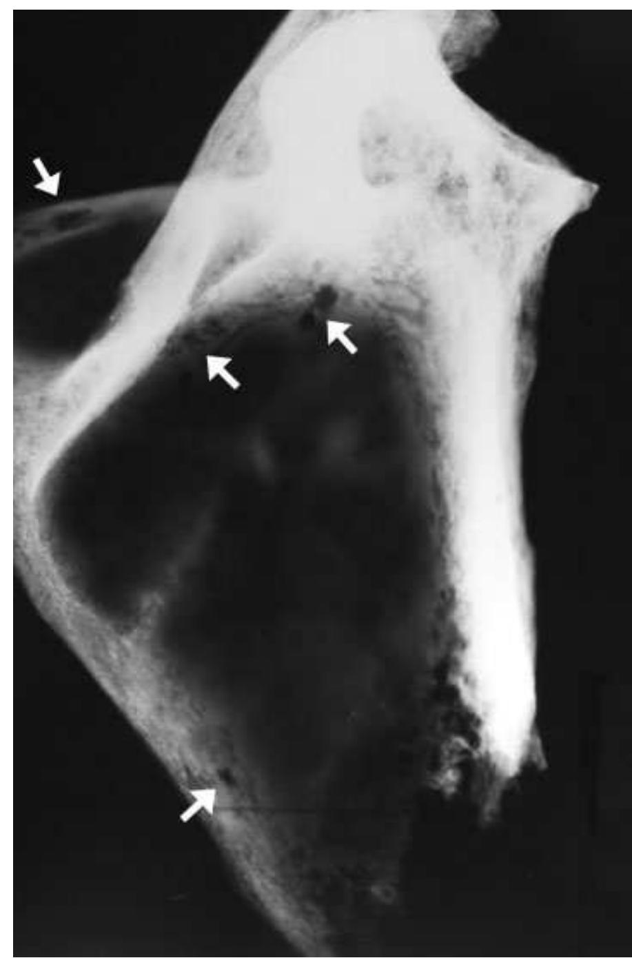 Rx image of the right scapula. the radiolucent zones are