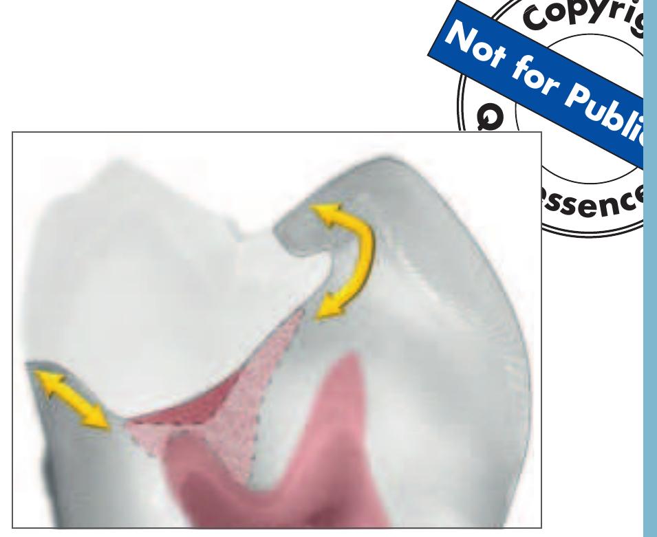 Caries removal end points for a deep lesion. the peripheral