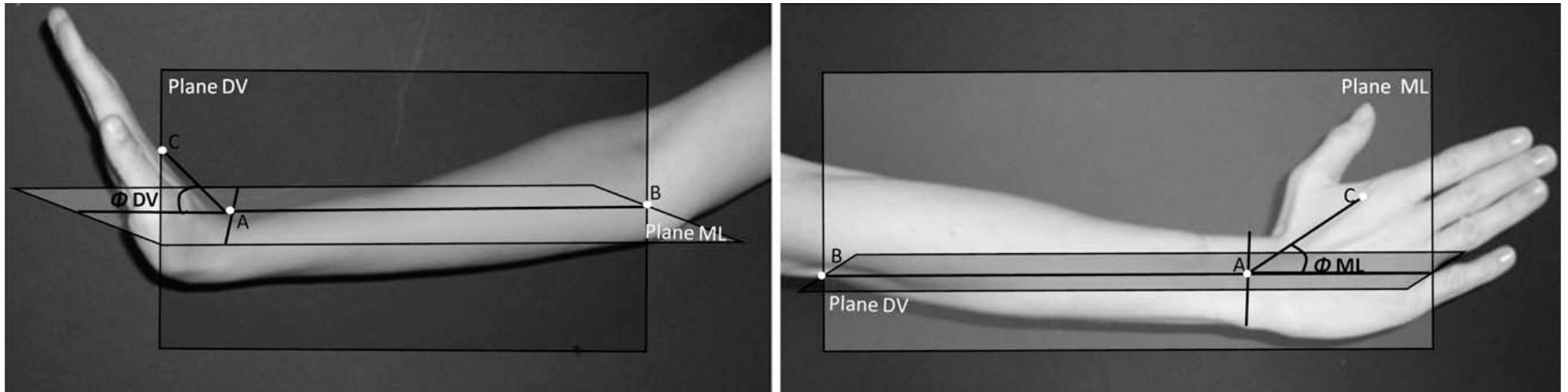 Lateral (a) and dorsal (b) views of the forearm with a