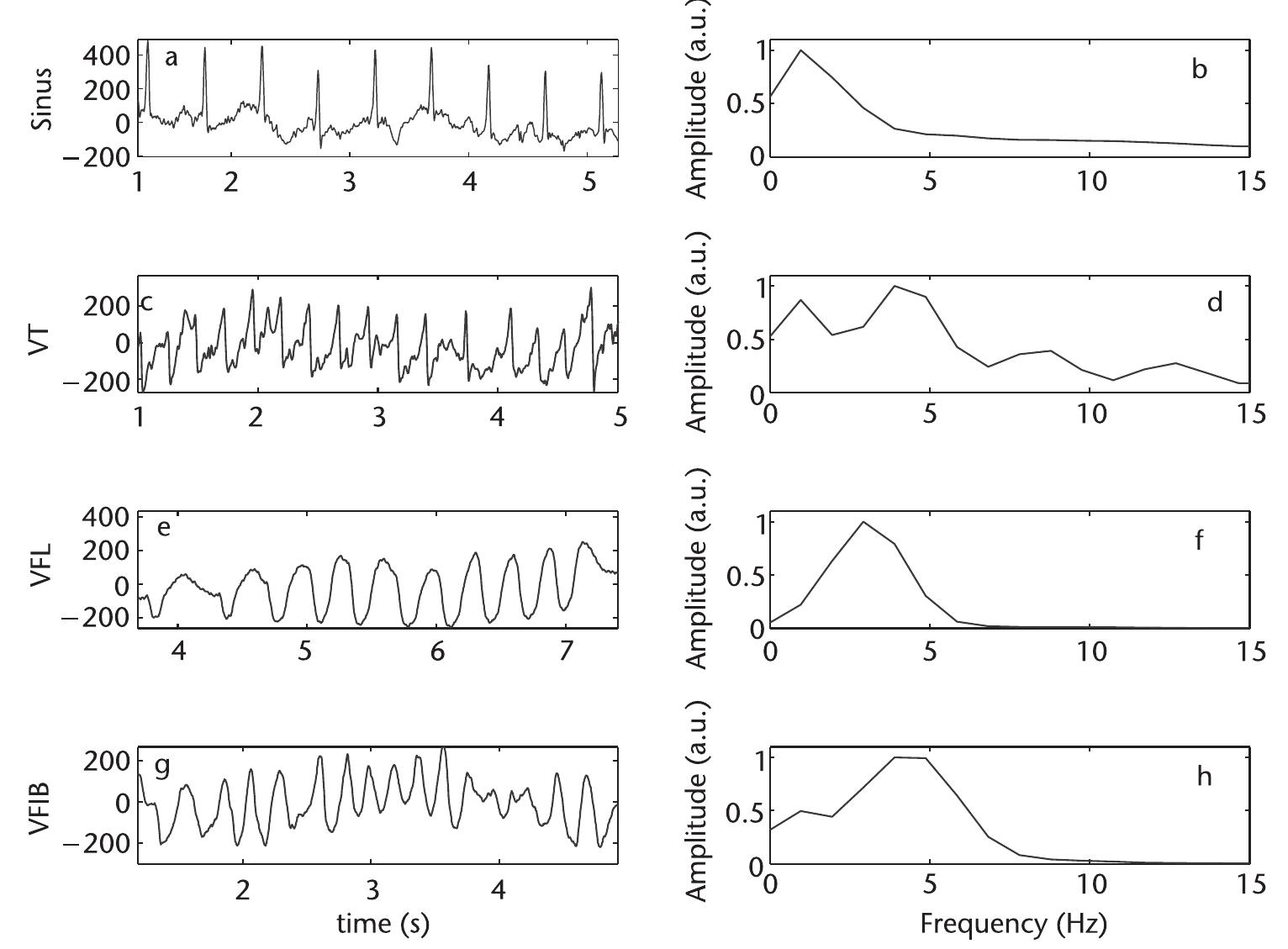 4 (a) sinus rhythm and (b) corresponding psd. (c)