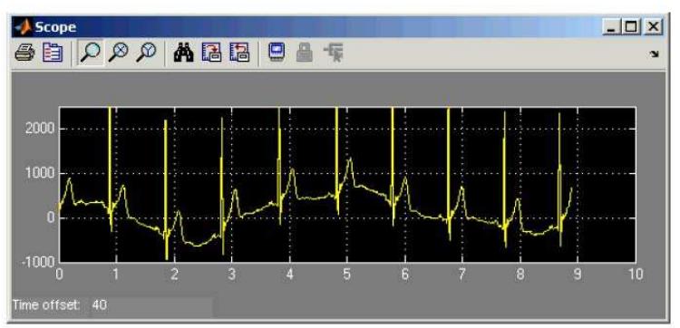 This simulink scope shows an acquired ecg signal with a