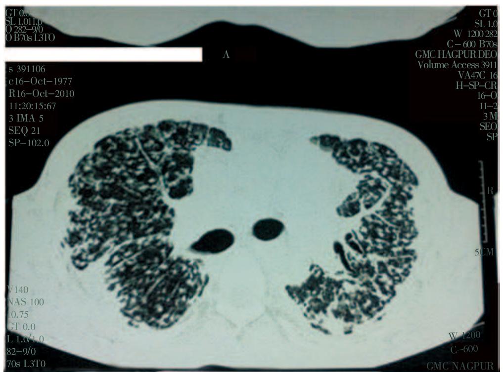 Hrct thorax done after bilateral chest tube removal.
