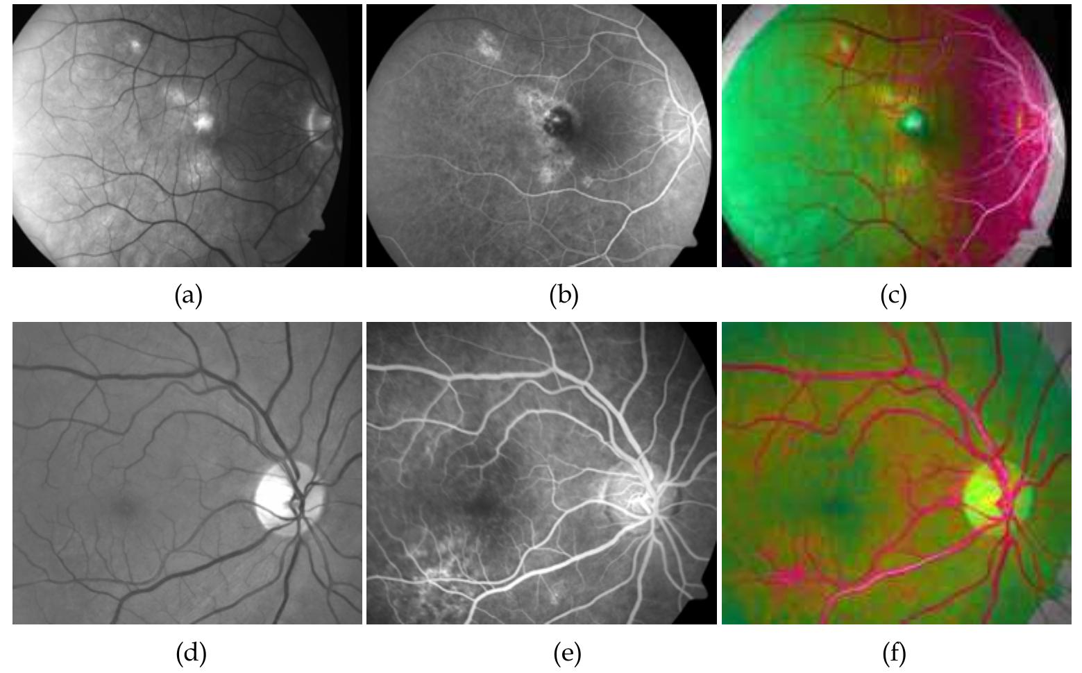 Angiogram images represent the macula, the arteries and