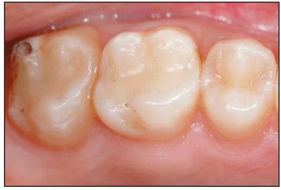 Preoperative occlusal view of tooth #2 showing a carious