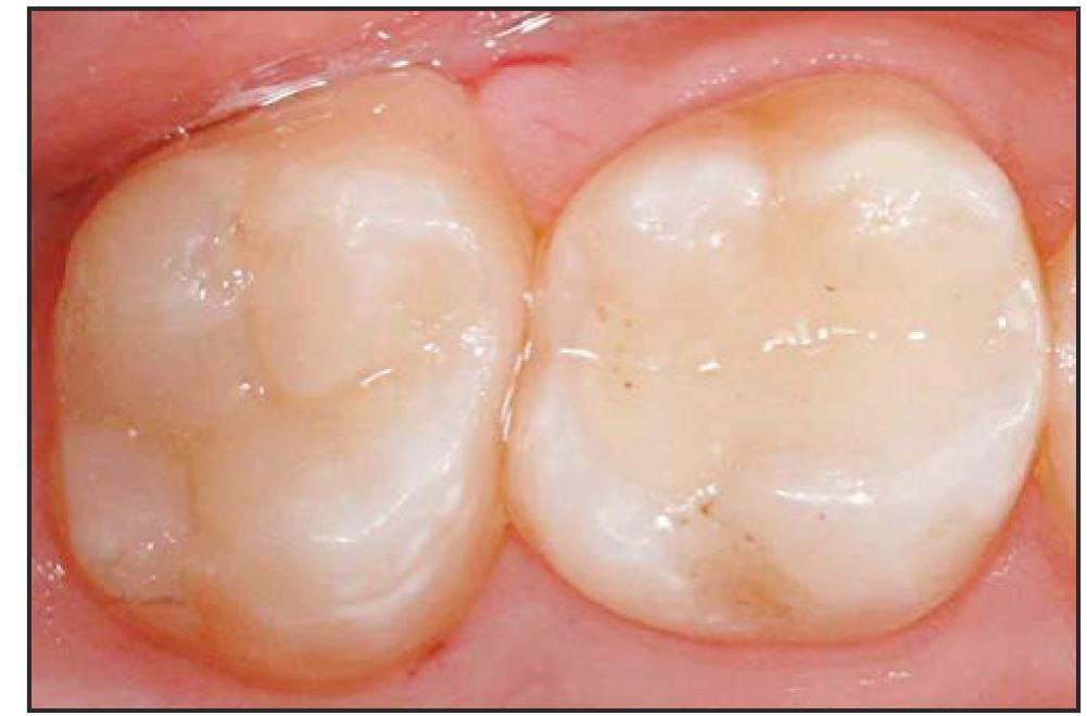 Postoperative occlusal view of the definitive srdc resto