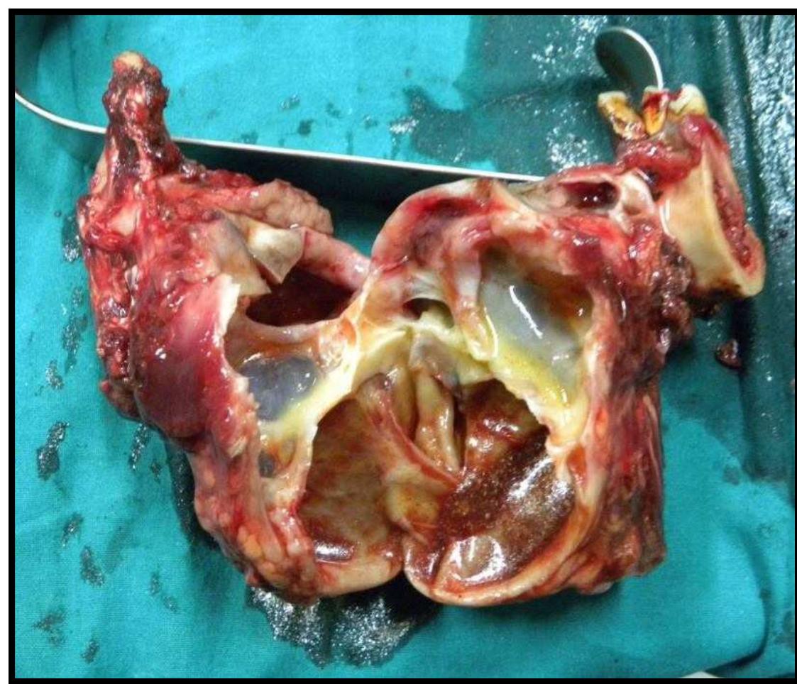 Cut specimen of resected mandible fig 4 - resected mandible