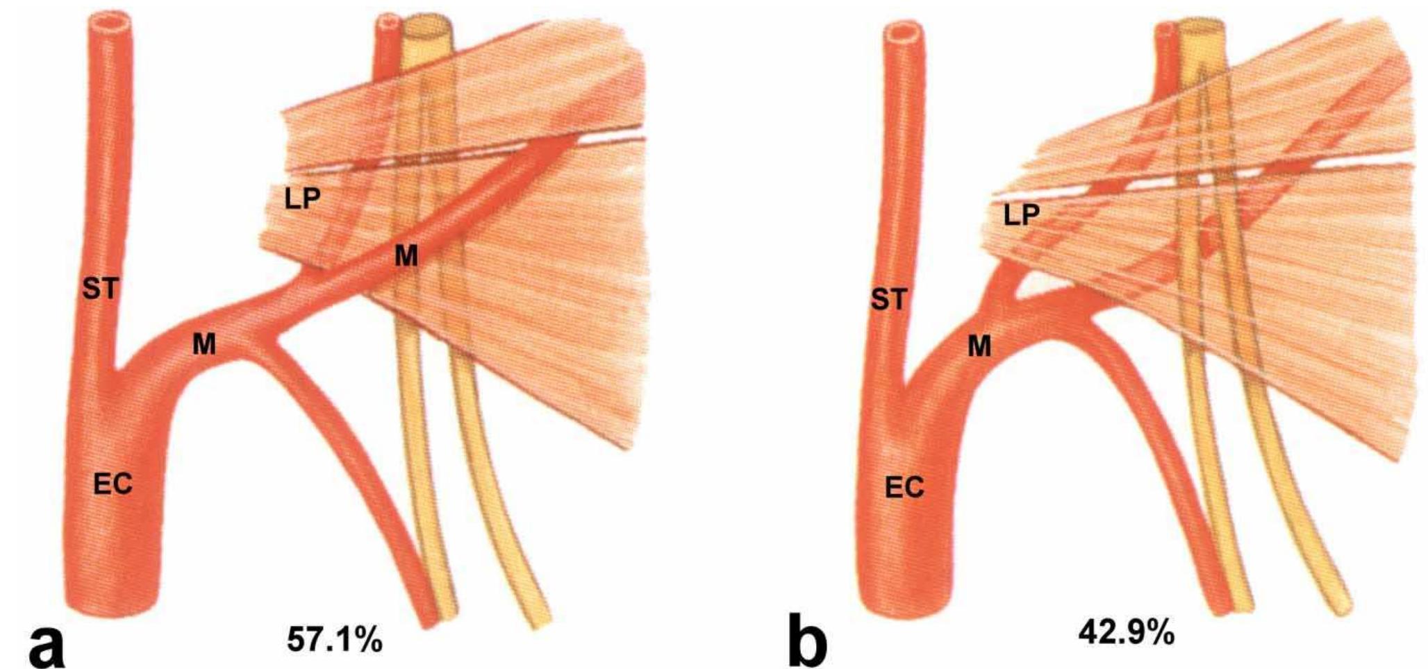 A-b. classification of maxillary artery (m) as superficial