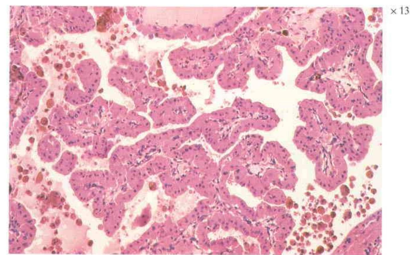 Papillary Carcinoma Oxyphilic Cell Type 0416
