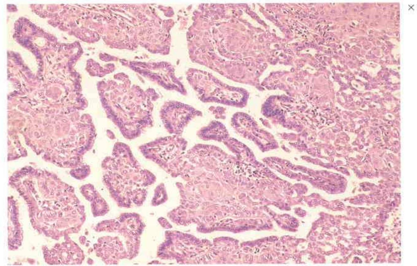 Papillary carcinoma, diffuse sclerosing variant with