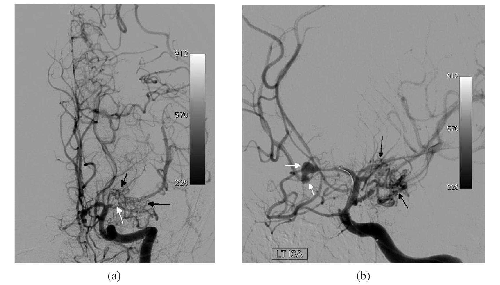 (a) towne view of the left internal carotid angiogram