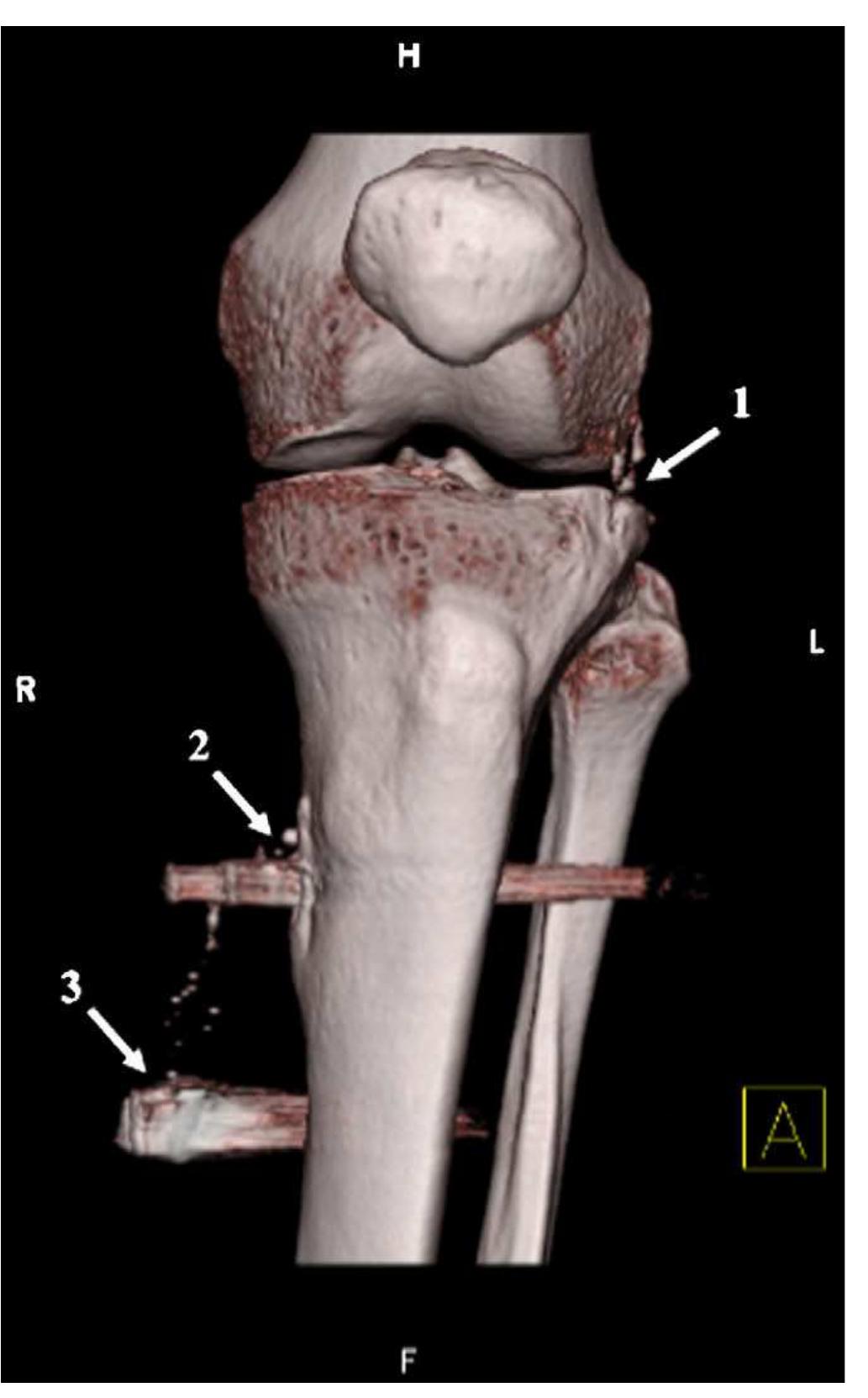 3d-volume rendered image (anterior aspect: a) revealing the