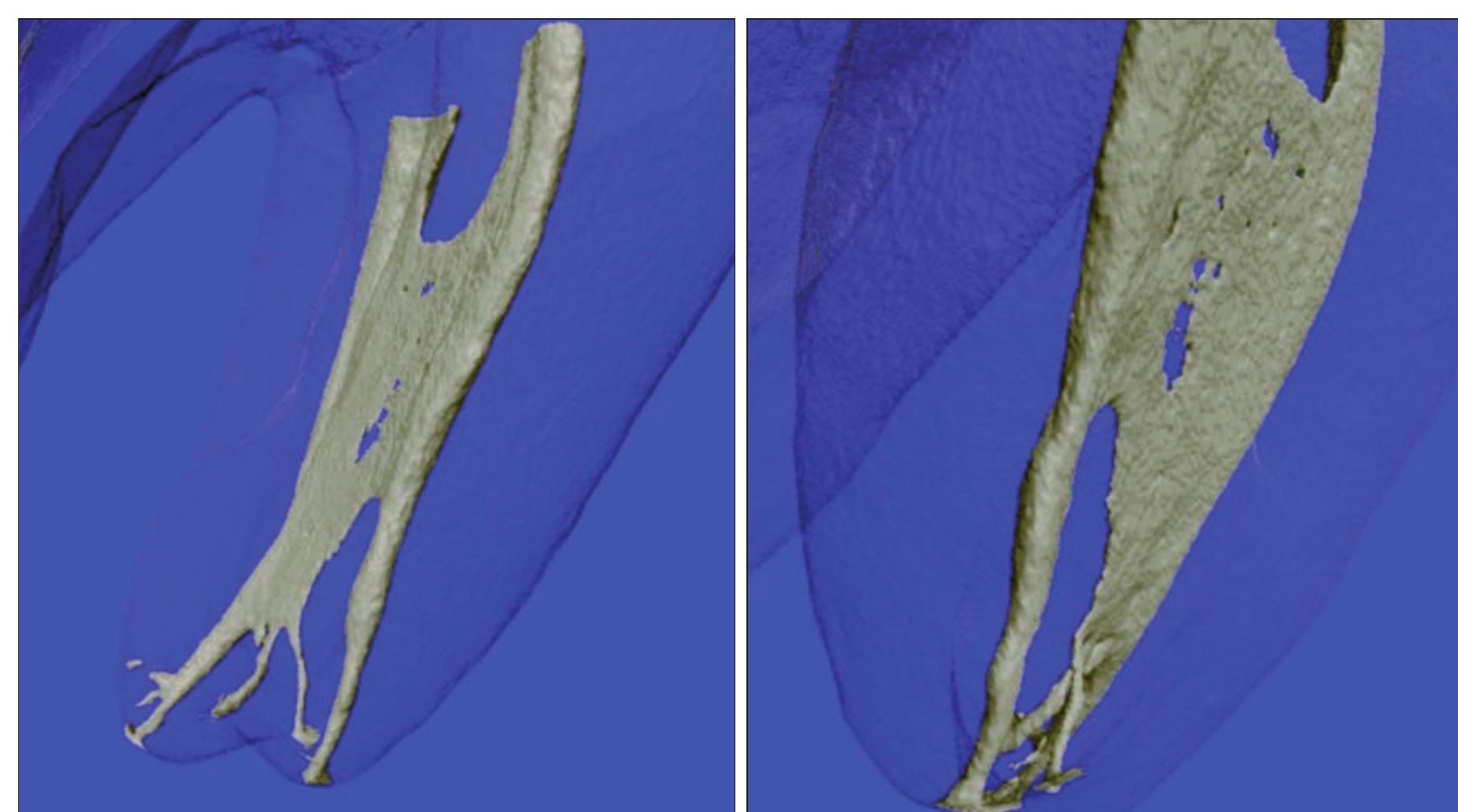 Root-canal complex (dti/photo courtesy of dr ronald ordinala