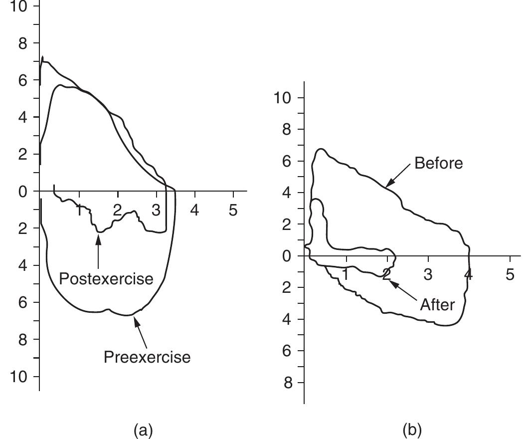 -7. flow-volume loops obtained before and when symptomatic