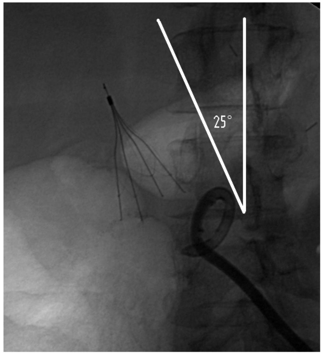 Example of vena cava filter tilting — tilting angle greater