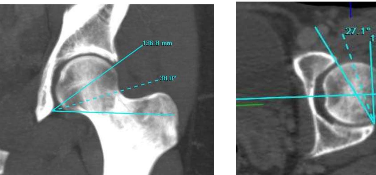 D. acetabular version (av) fig lc. acetabular angle of