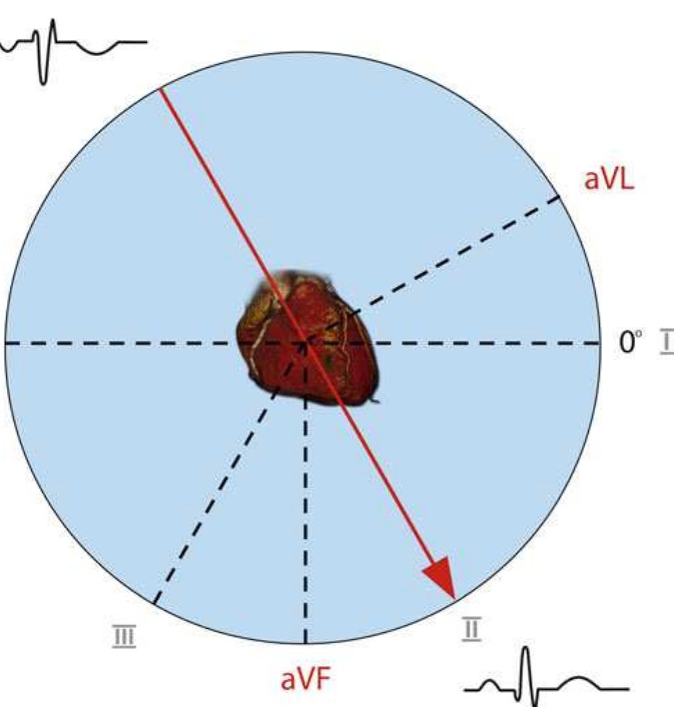 18 the morphology of the ecg in leads avr and ii. positive