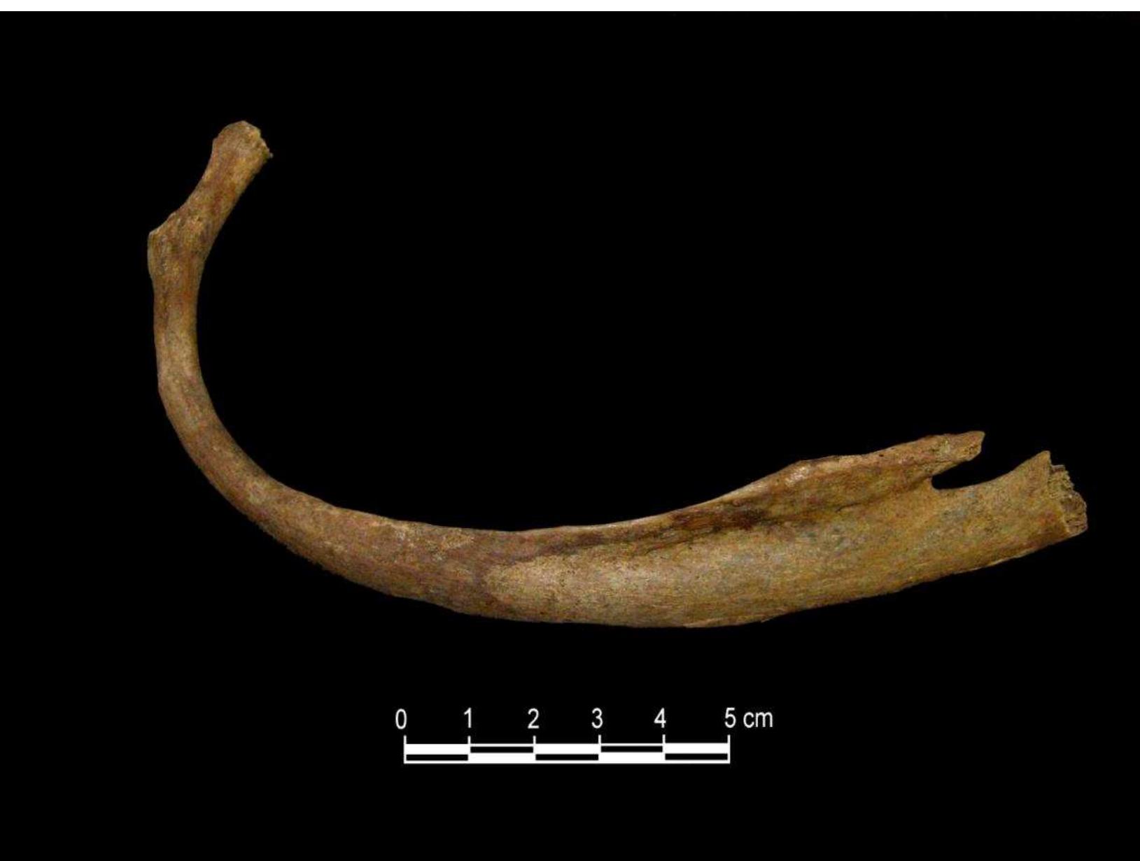 -5 bifid right rib, unstratified and disarticulated. photo a