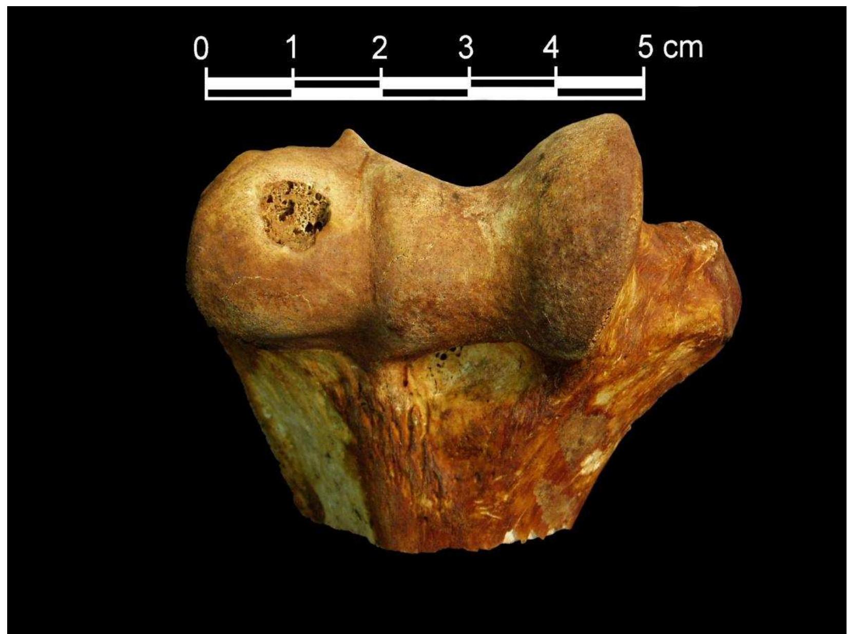 -12 osteochondritis dissecans present on the capitulum on a