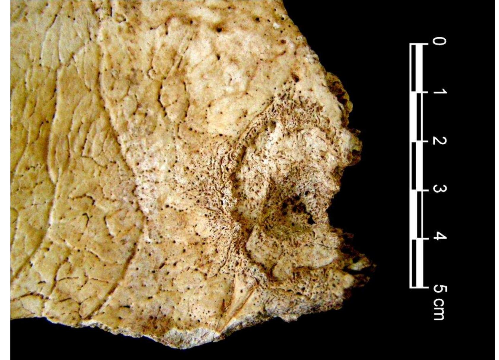 -26 endocranial surface showing cranial tuberculosis with a