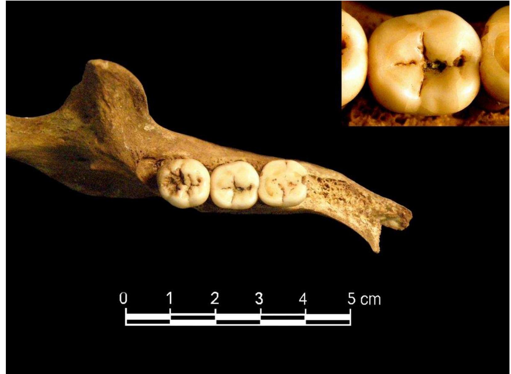 -45 a grey metal filling present on the occlusal surface of