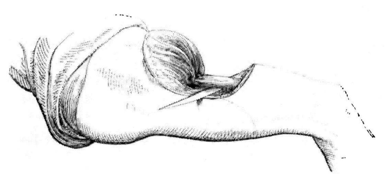 -5 an amputation made by producing an anterior and a