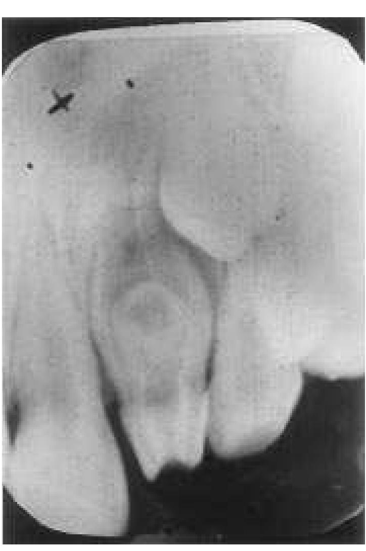 Severe invagination malformation of tooth 22 resulting in
