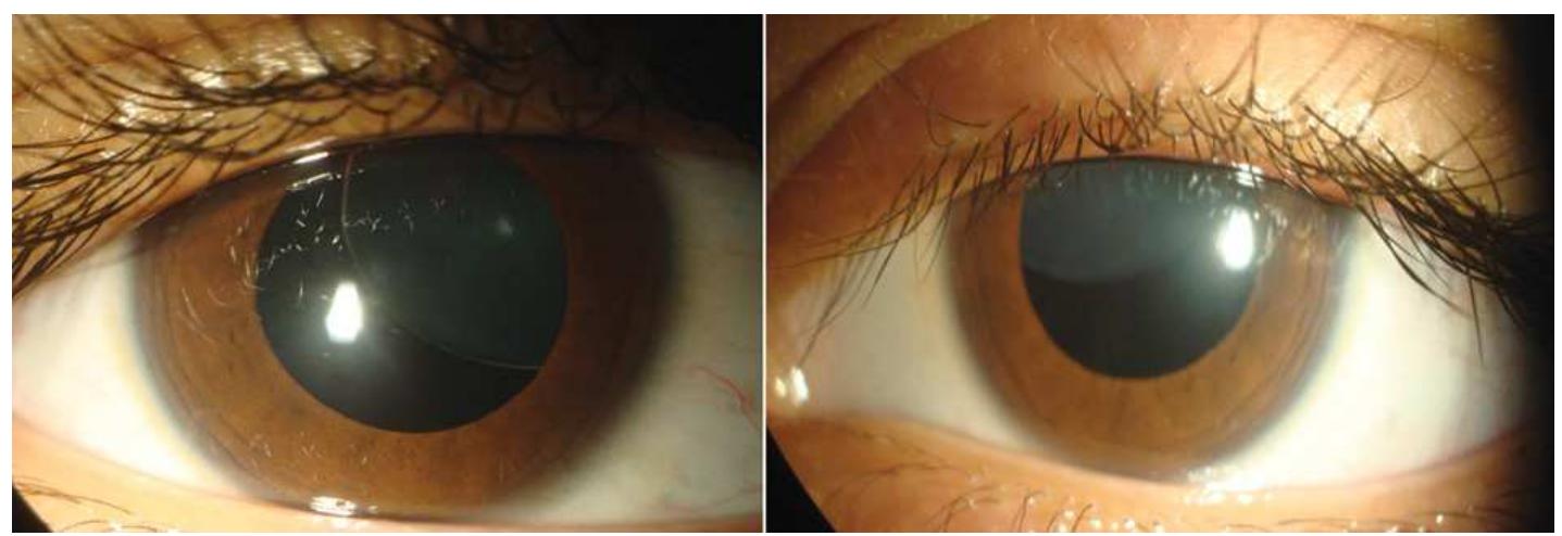 Clinical photograph showing subluxation of the crystalline