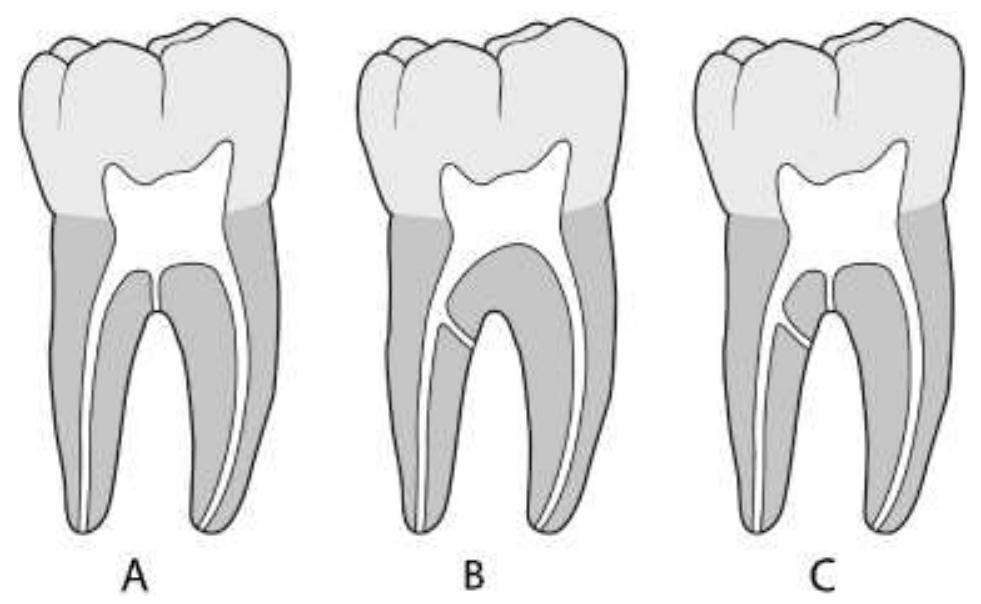 (PDF) 2005 Vertucci - Root canal morphology and its relationship to ...