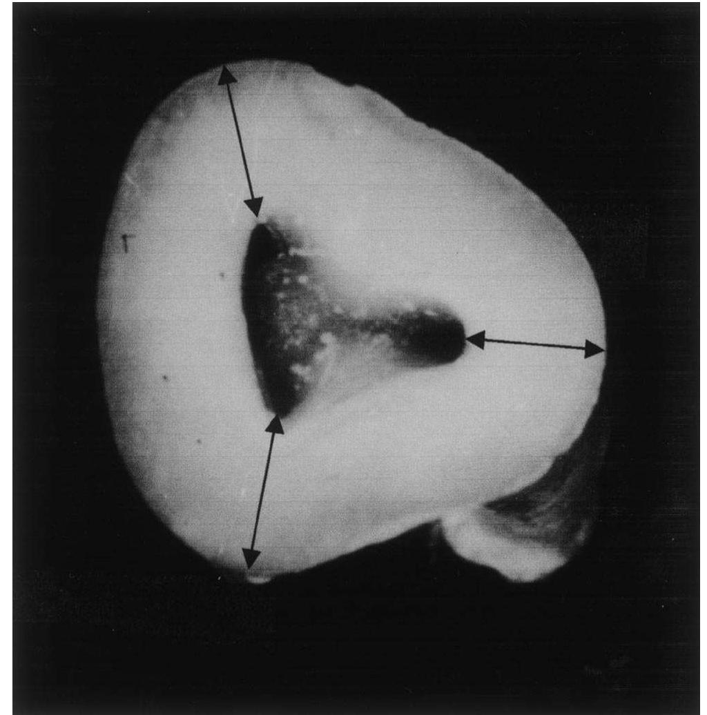 Fic 3. cut specimen of a mandibular molar showing the
