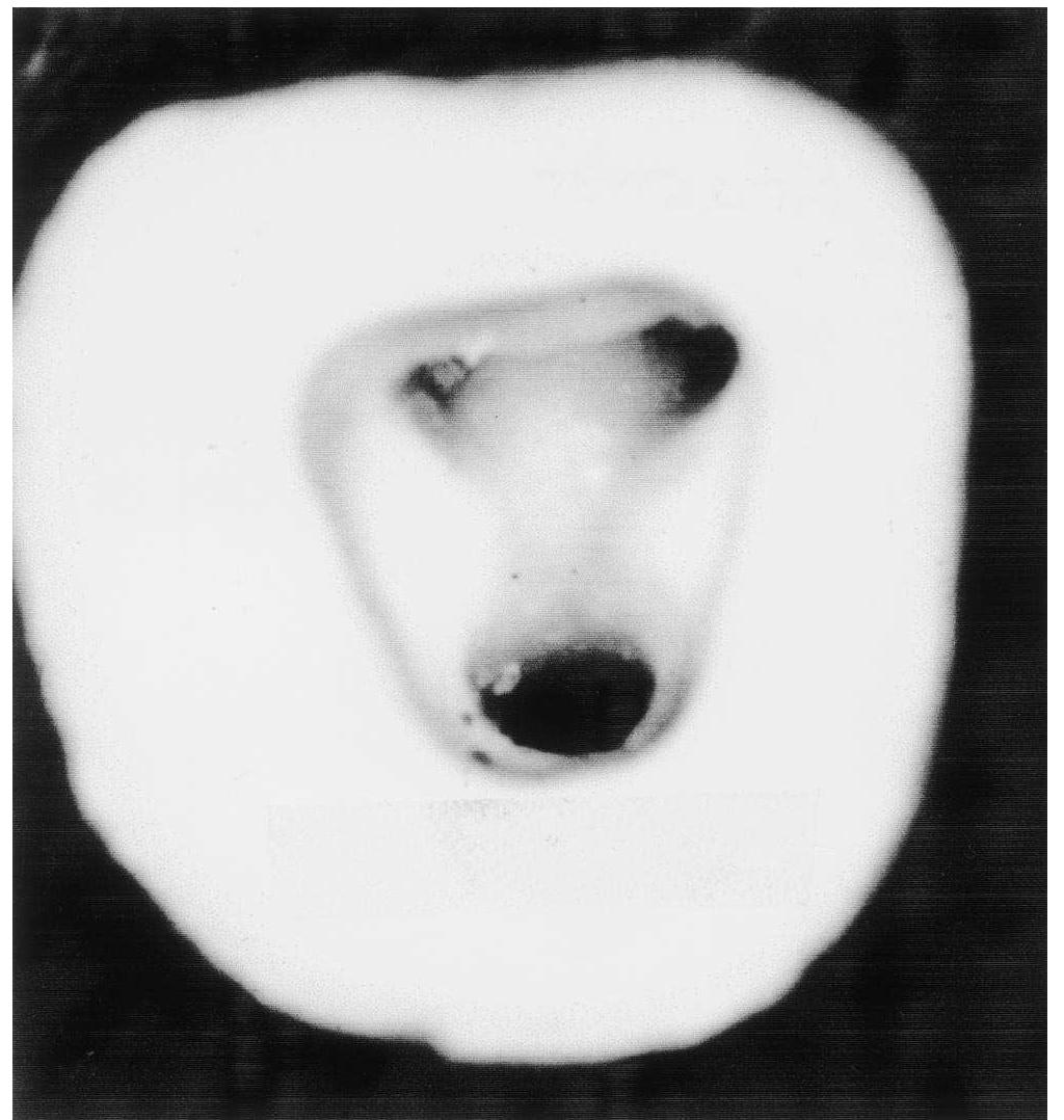 (PDF) 2004 Krasner - Anatomy of the Pulp-Chamber Floor