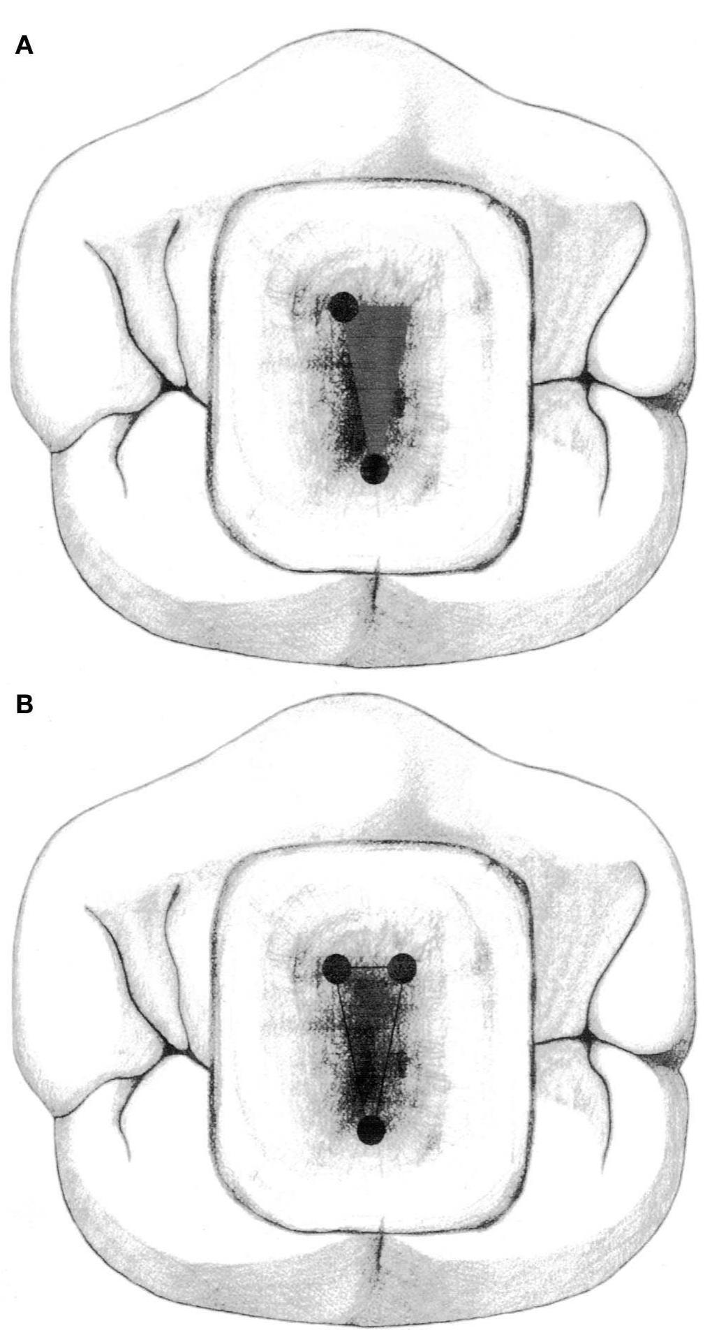 (PDF) 2004 Krasner - Anatomy of the Pulp-Chamber Floor