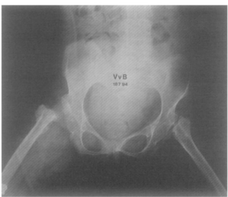 Bilateral hip dislocation treated by girdlestone excision