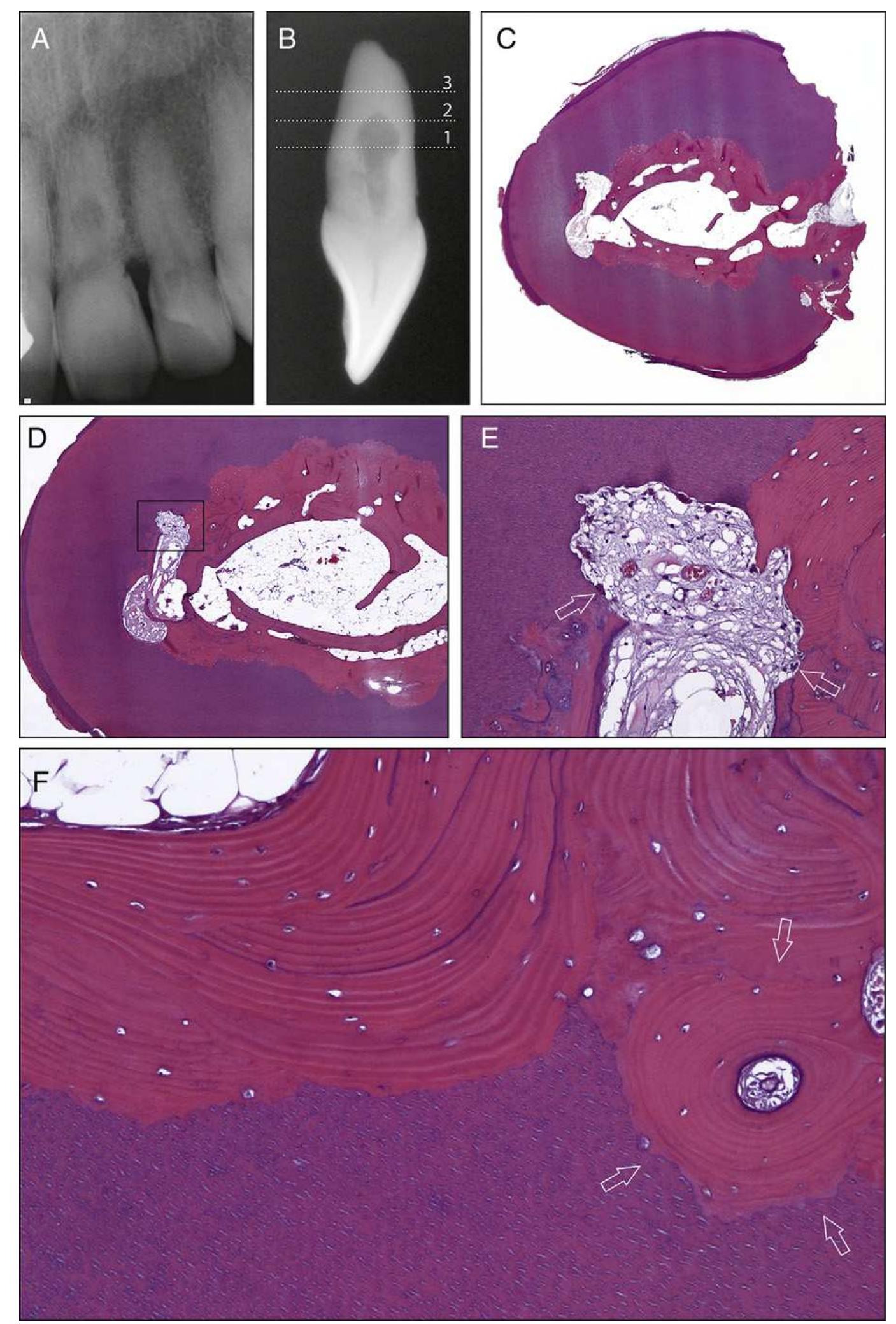 Figure 4 - from 2010 Patel - Internal Root Resorption: A