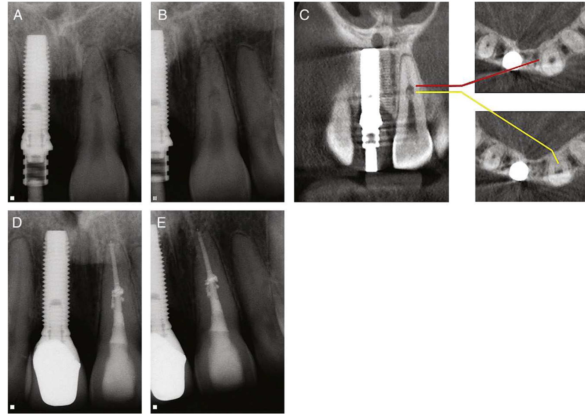 (a, b) radiographs reveal internal (root canal) replacement