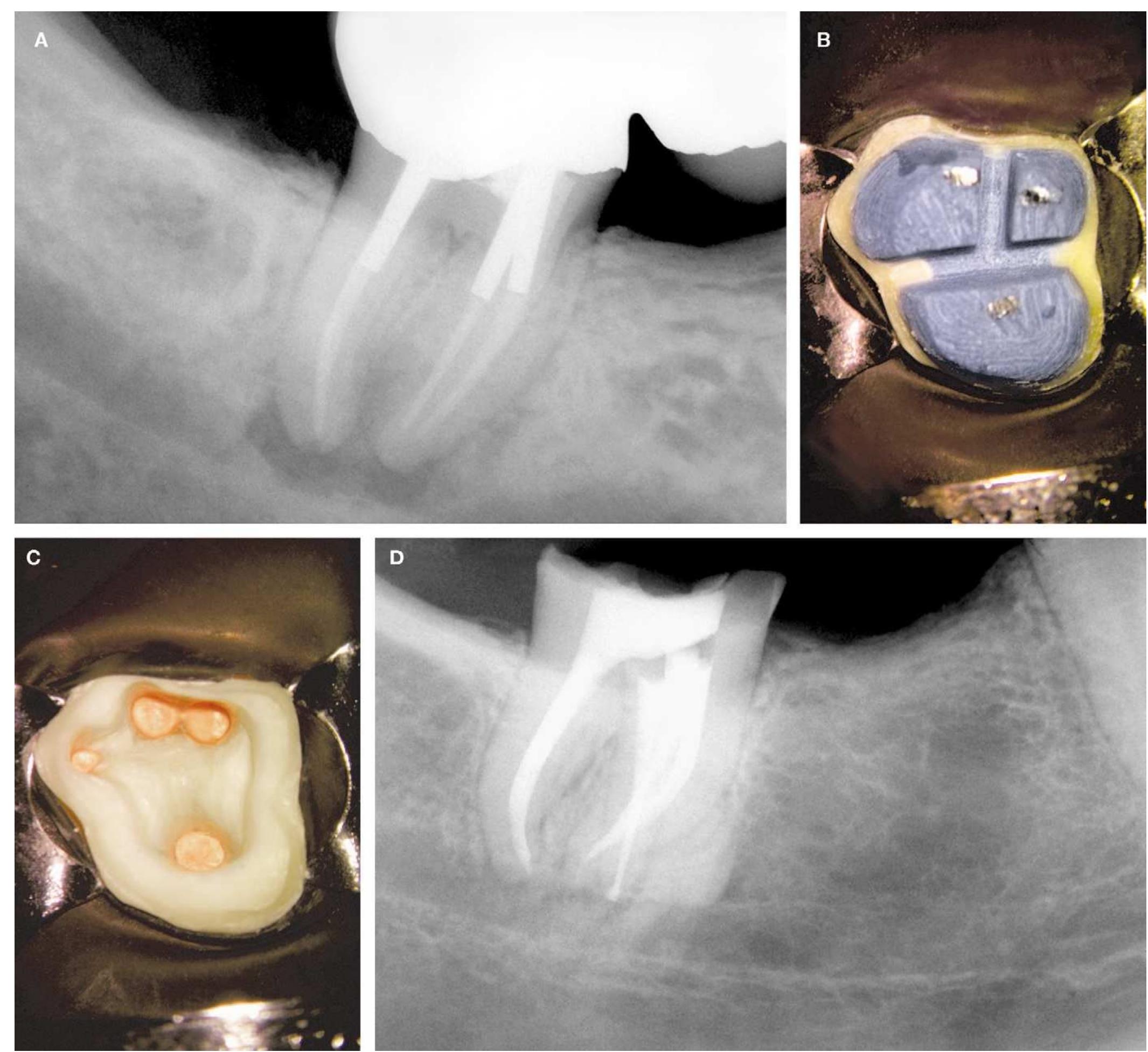 Fic 8. (a) a preoperative radiograph of a mandibular right