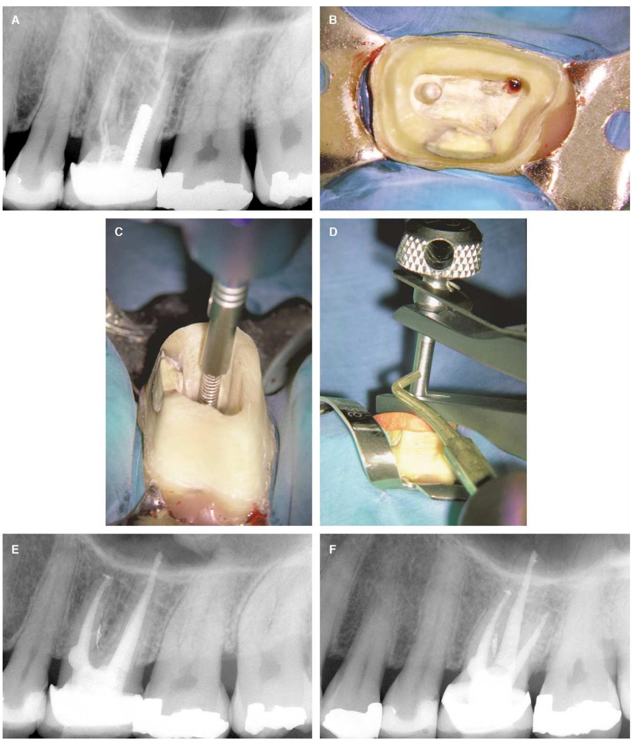 (a) a radiograph shows incomplete endodontics and resultant