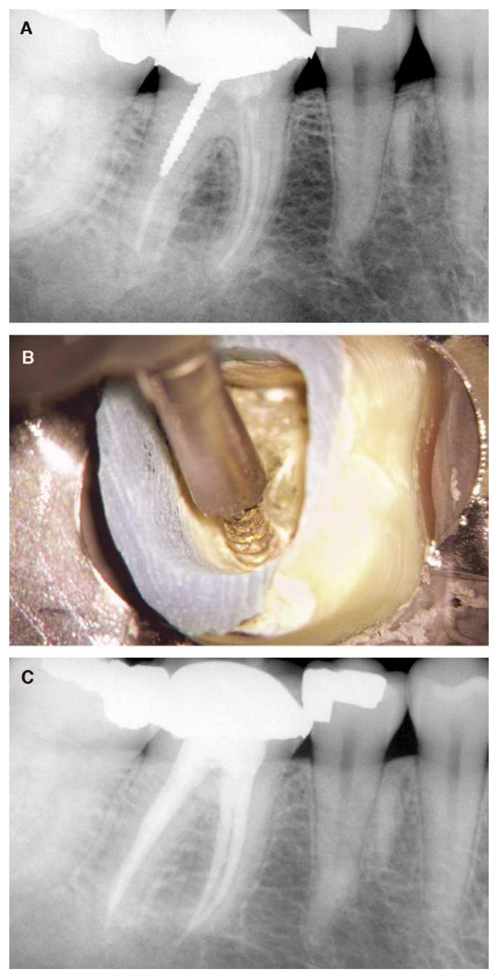 (a) a radiograph of a mandibular right first molar demon-