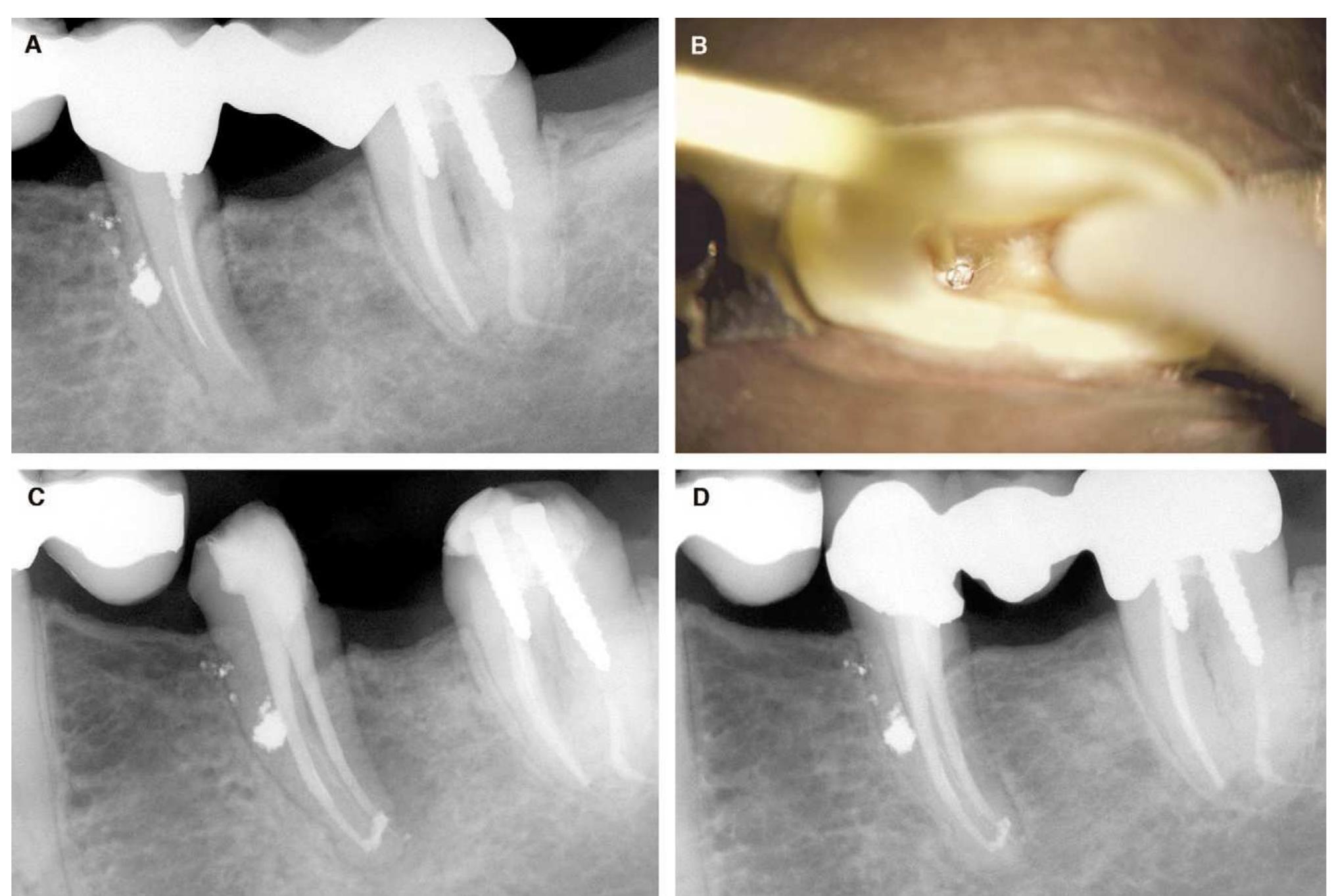 (a) an endodontically failing mandibular first molar. note a